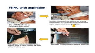 Fine needle aspiration cytology fnac pathology | PPTX