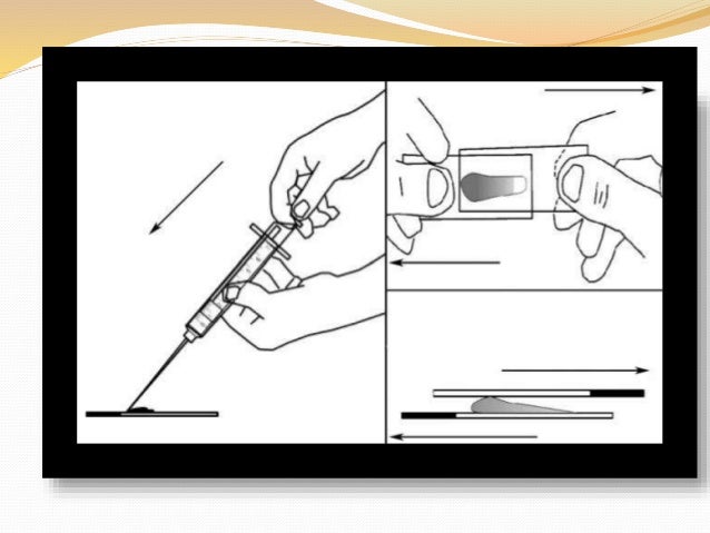 fine needle aspiration cytology by rahul raj