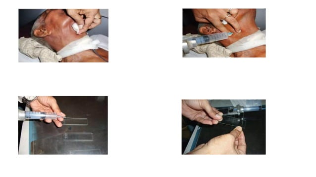 FINE NEEDLE ASPIRATION CYTOLOGY TECHNIQUE | PPTX | Medical Tests ...