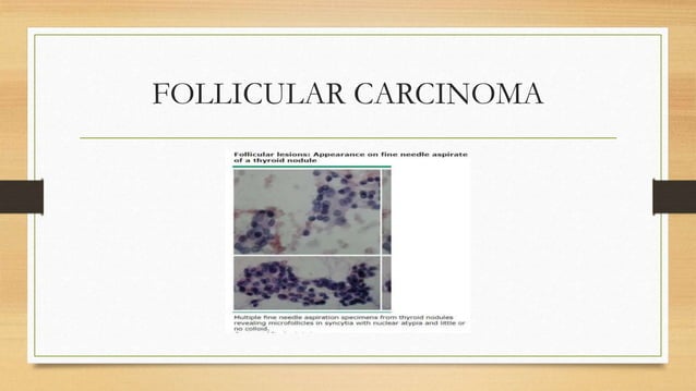 Fnac thyroid | PPTX