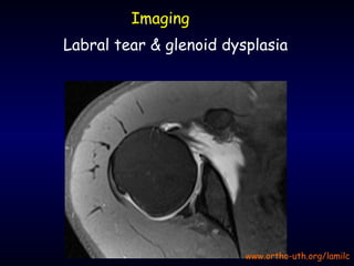 Posterior instability | PPT