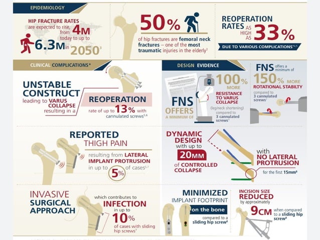 FFEMORAL NECK SYSTEM IN NECK FEMUR FRACTURES | PPTX