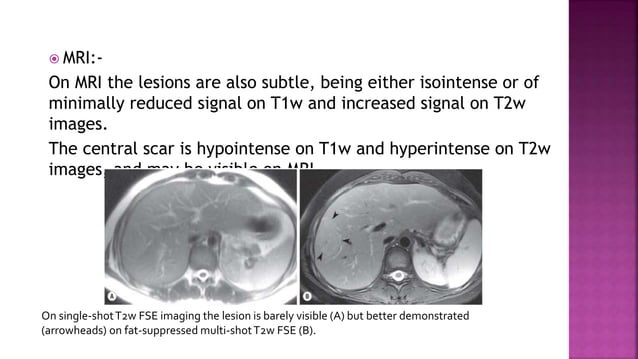 Focal and diffuse lesions of liver | PPTX