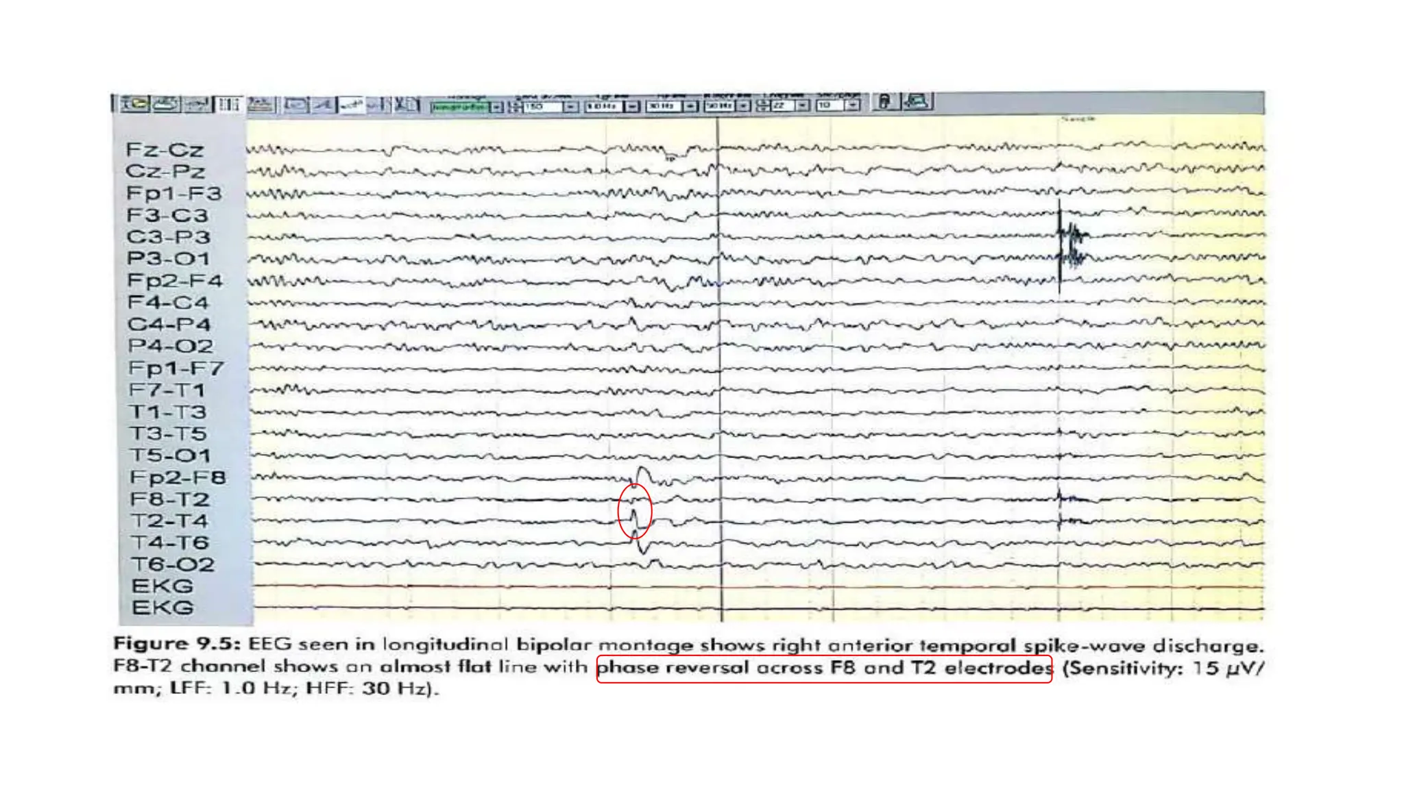 Focal epileptiform patterns principles of polarity | PPT
