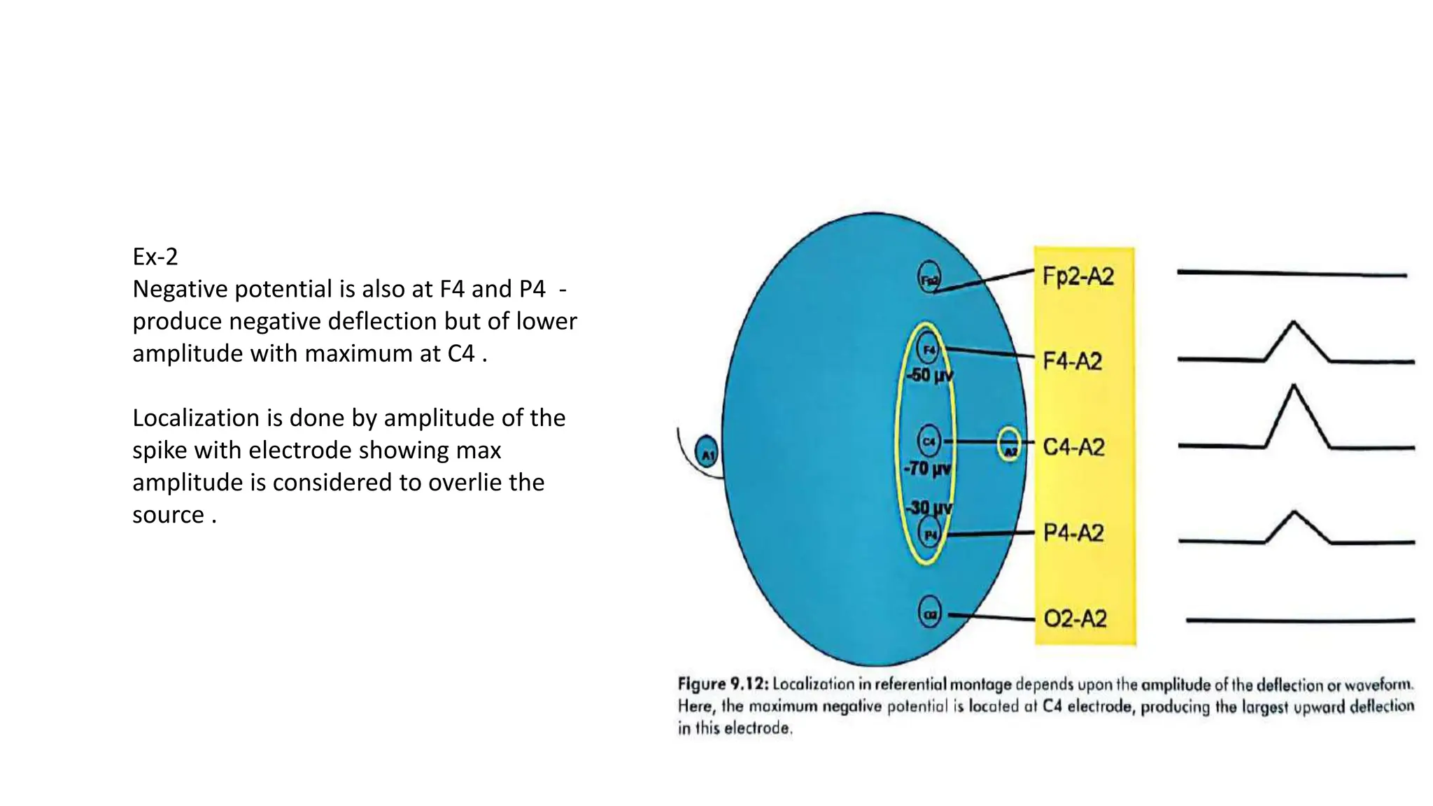 Focal epileptiform patterns principles of polarity | PPT