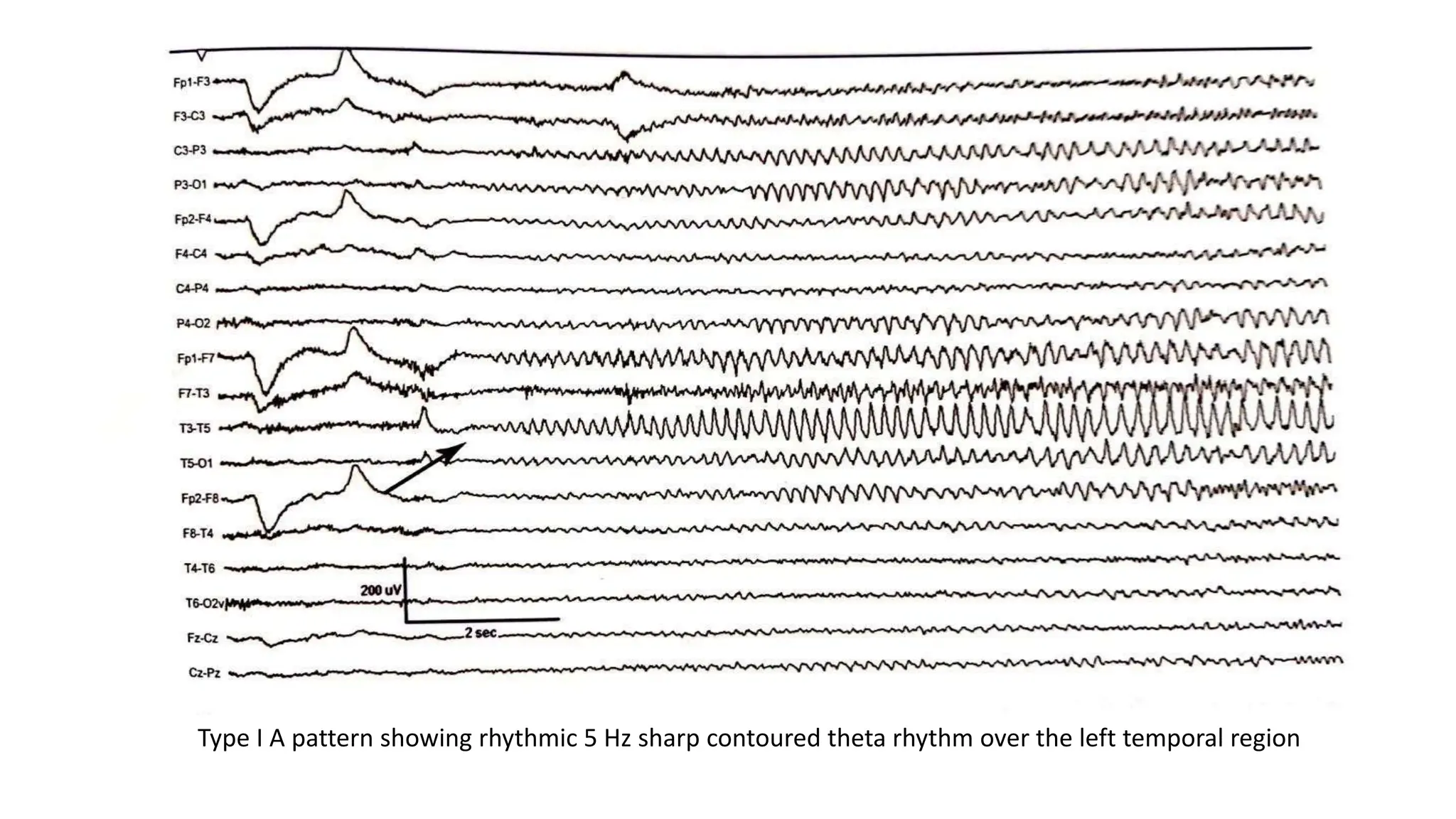 Focal epileptiform patterns principles of polarity | PPT