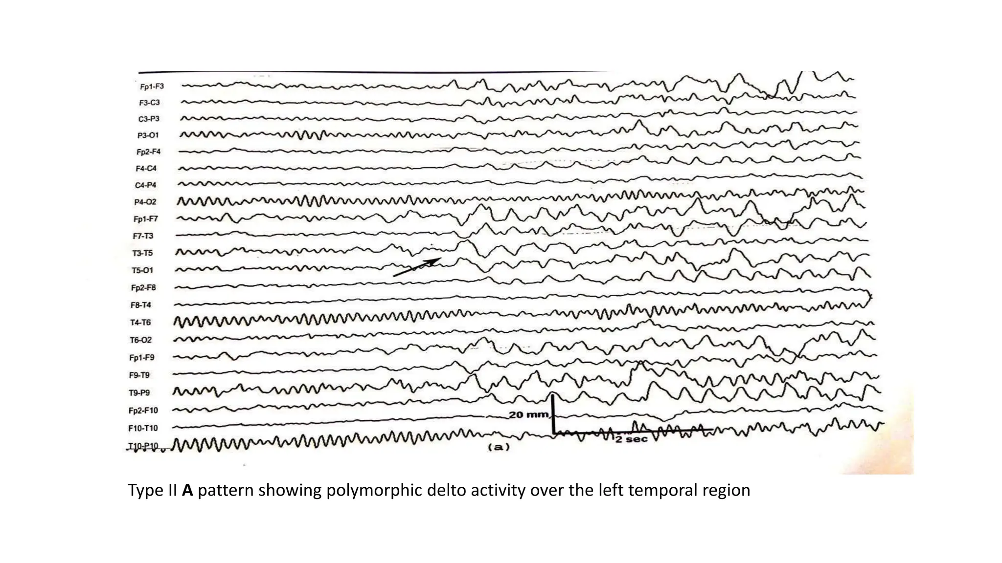 Focal epileptiform patterns principles of polarity | PPTX