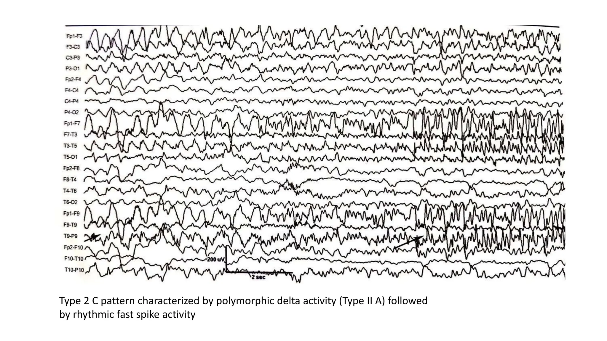 Focal epileptiform patterns principles of polarity | PPT