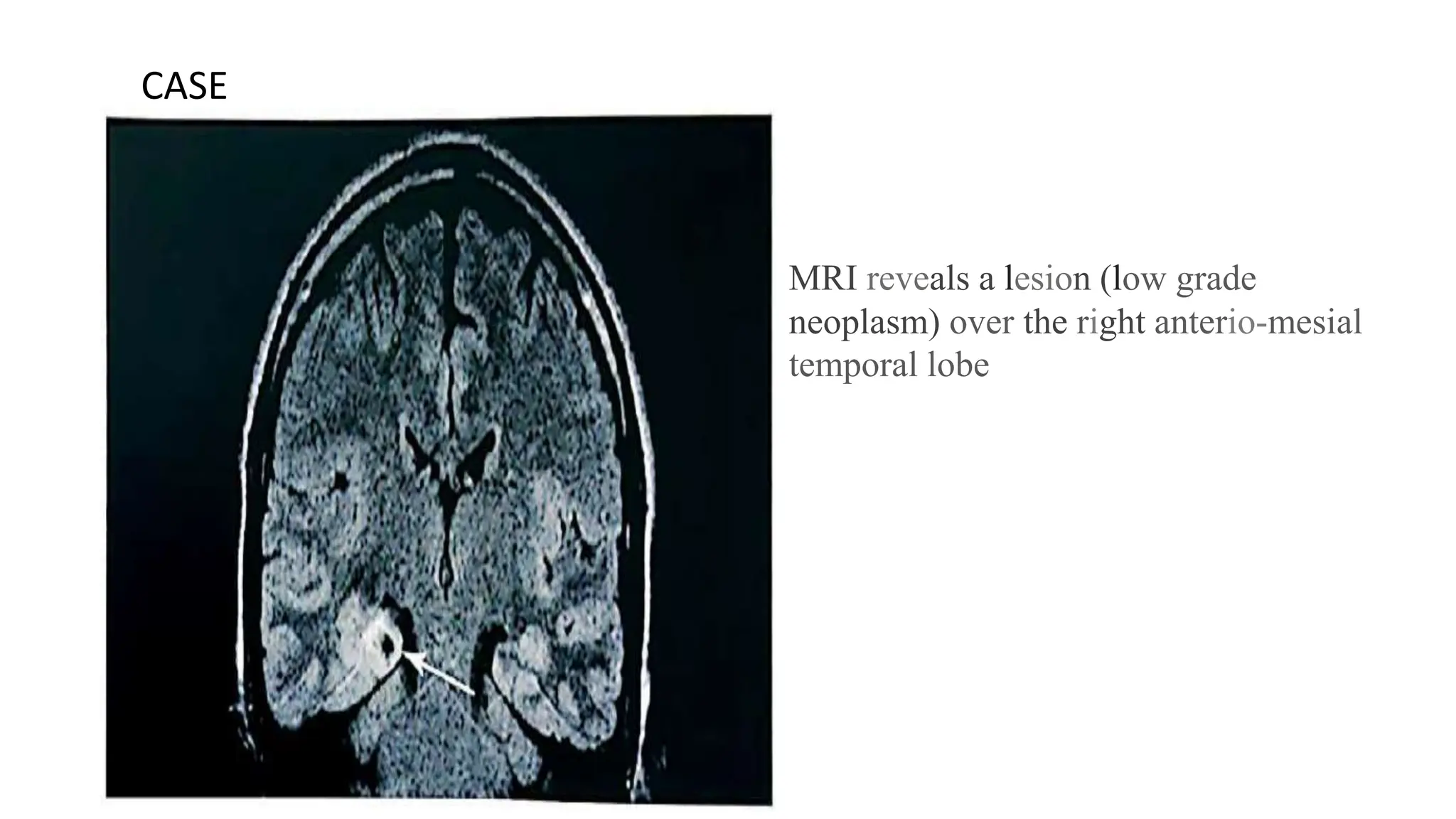 Focal epileptiform patterns principles of polarity | PPT