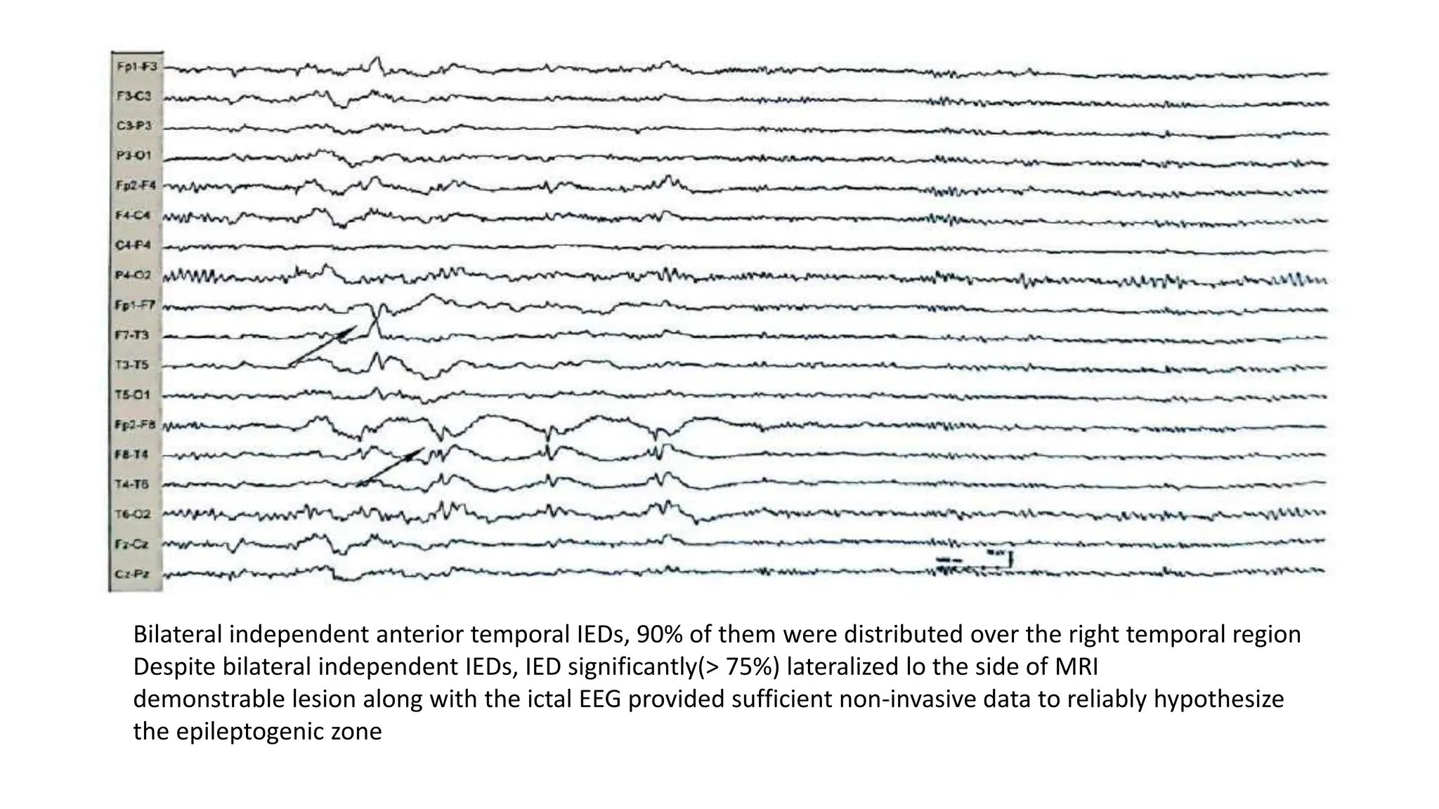 Focal epileptiform patterns principles of polarity | PPT