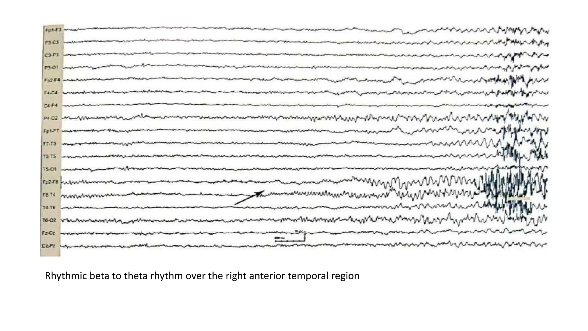 Focal epileptiform patterns principles of polarity | PPT