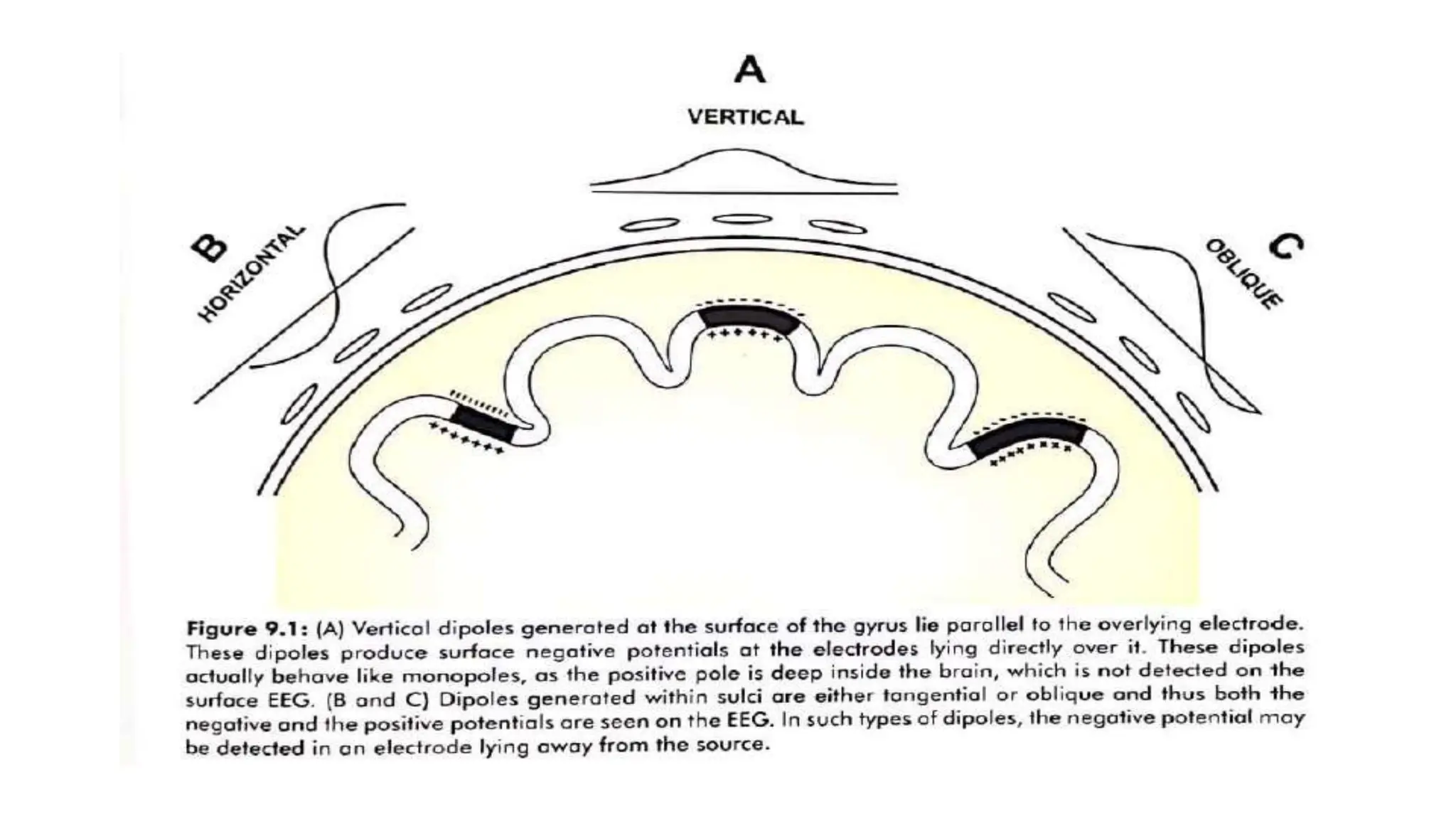 Focal epileptiform patterns principles of polarity | PPT