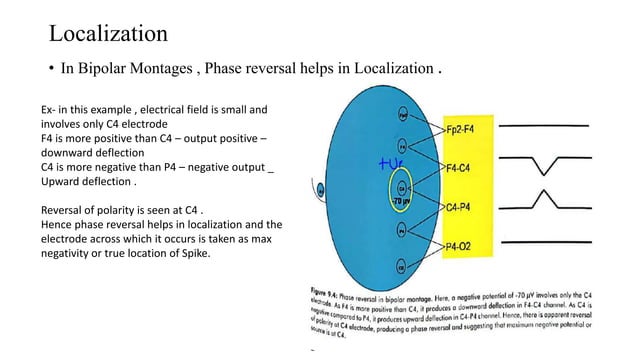 Focal epileptiform patterns principles of polarity | PPT