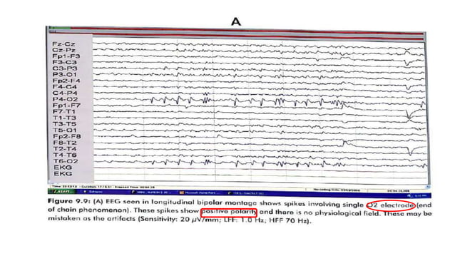 Focal epileptiform patterns principles of polarity | PPT