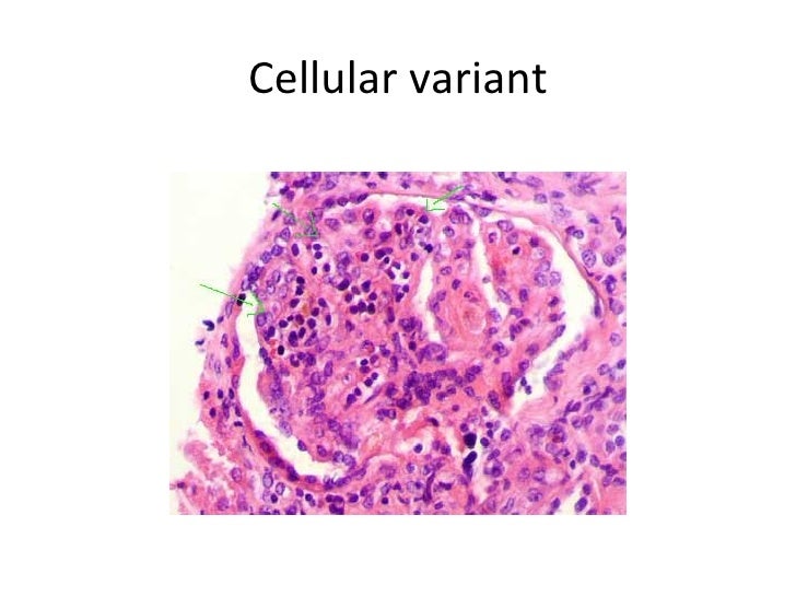 Focal Glomerulosclerosis
