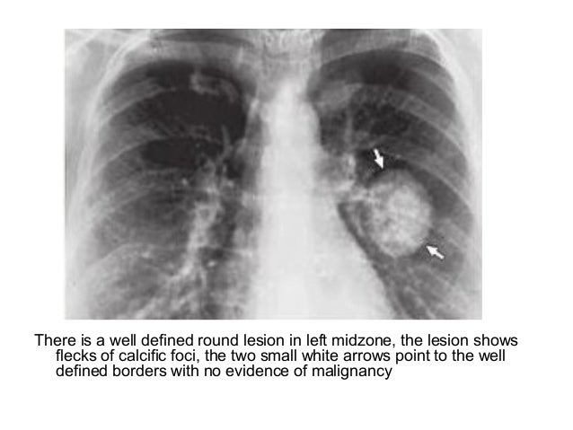 Diagnostic Imaging of Focal Lung Lesions