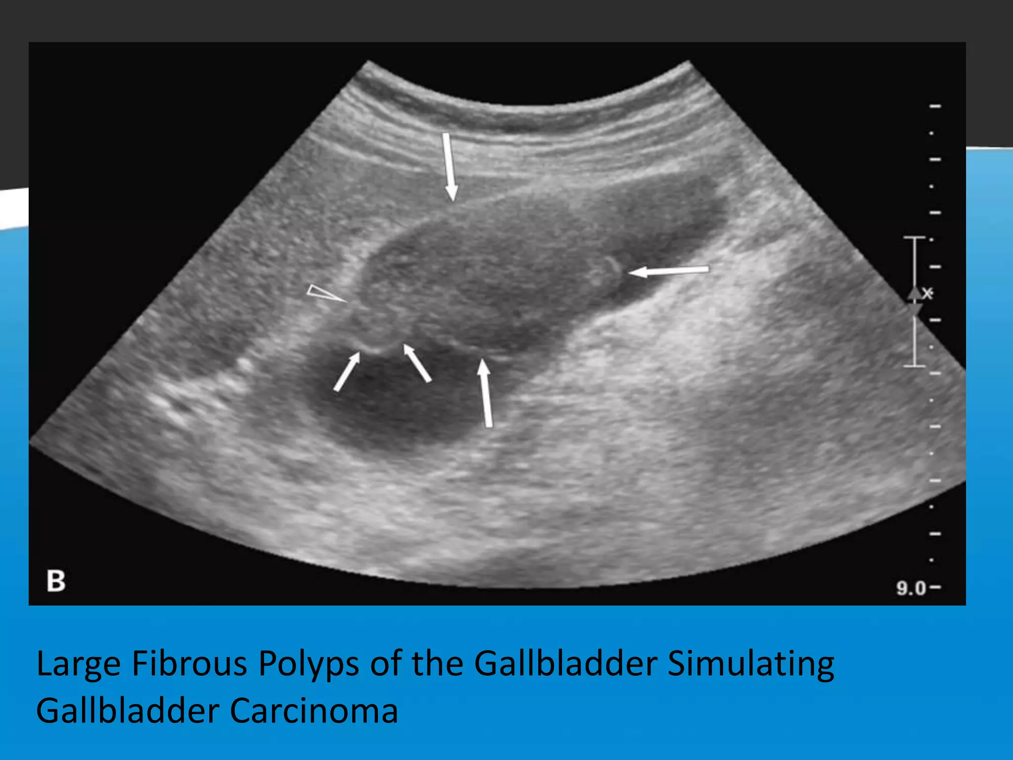 Focal vs diffuse gall bladder wall thickening | PPTX