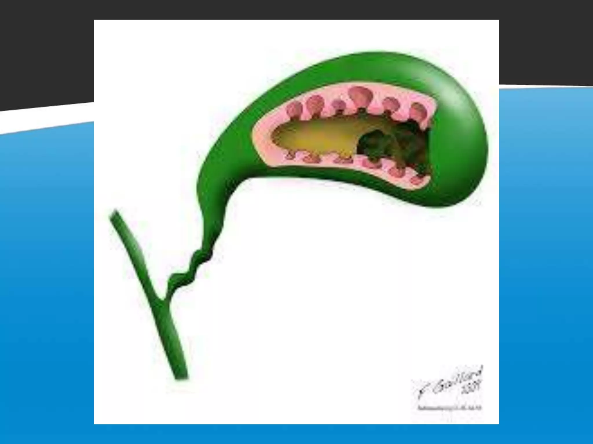 Focal vs diffuse gall bladder wall thickening | PPTX
