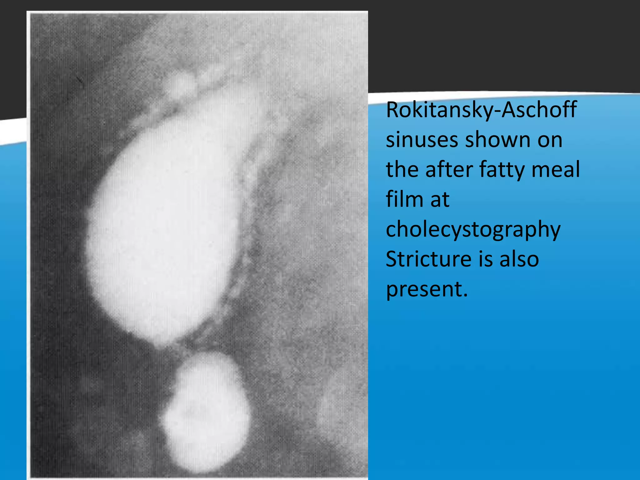 Focal vs diffuse gall bladder wall thickening | PPTX