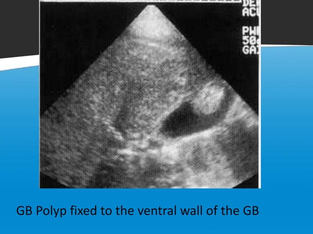 Focal vs diffuse gall bladder wall thickening | PPTX | Digestive ...