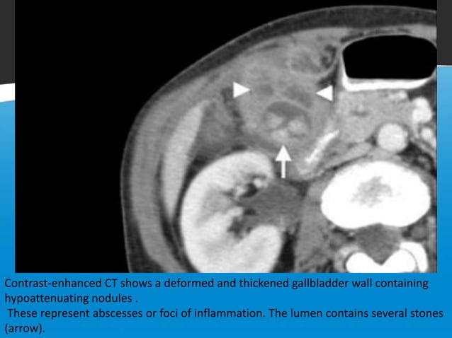 Focal vs diffuse gall bladder wall thickening | PPTX | Digestive ...