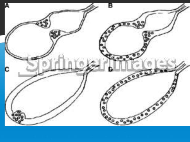 Focal vs diffuse gall bladder wall thickening | PPTX | Digestive ...