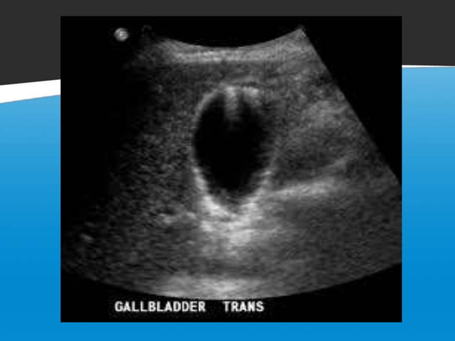 Focal vs diffuse gall bladder wall thickening | PPTX | Digestive ...