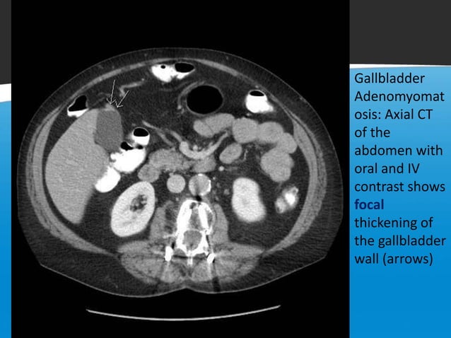 Focal vs diffuse gall bladder wall thickening | PPT