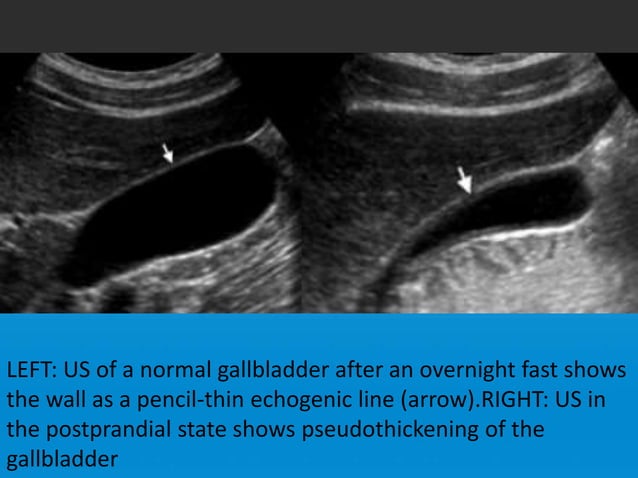 Focal vs diffuse gall bladder wall thickening | PPTX | Digestive ...