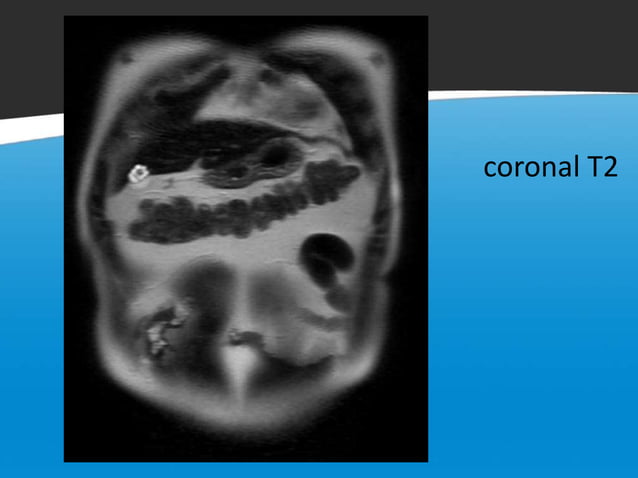 Focal vs diffuse gall bladder wall thickening | PPTX | Digestive ...