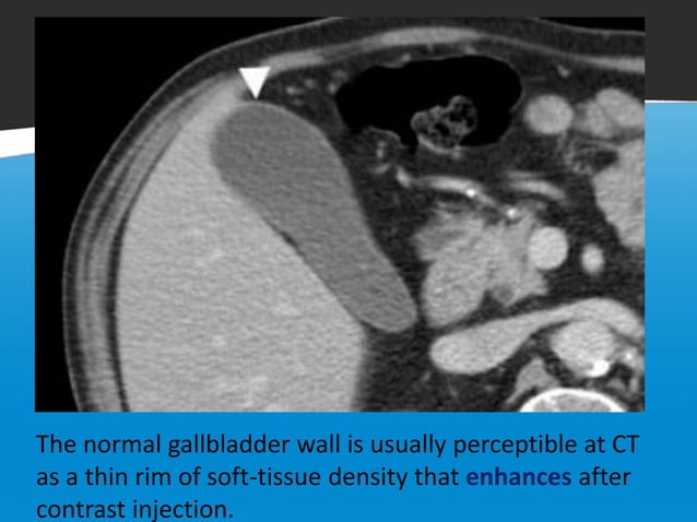 Focal vs diffuse gall bladder wall thickening | PPTX | Digestive ...