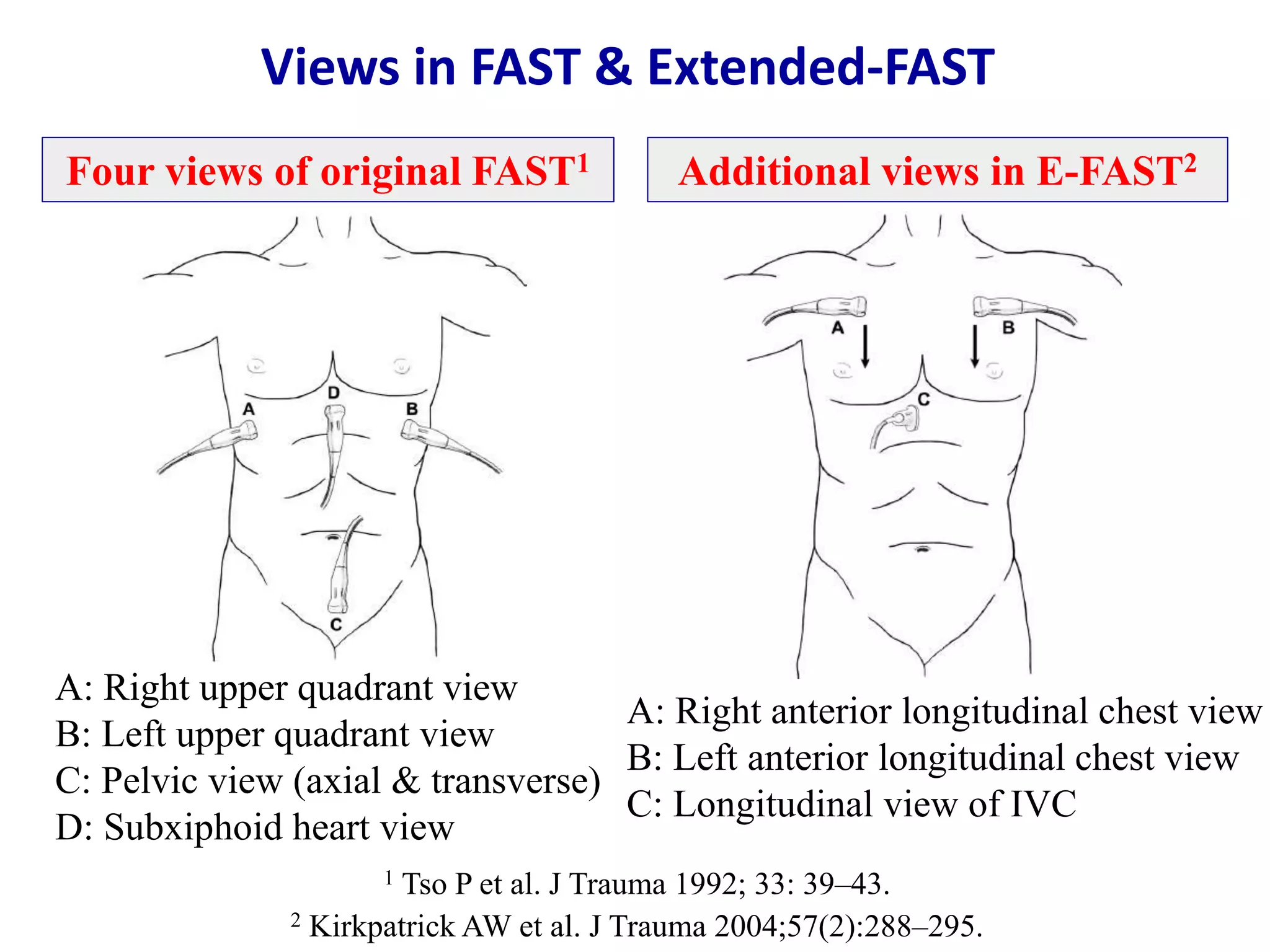Extended focus assessment with sonography for trauma | PPTX