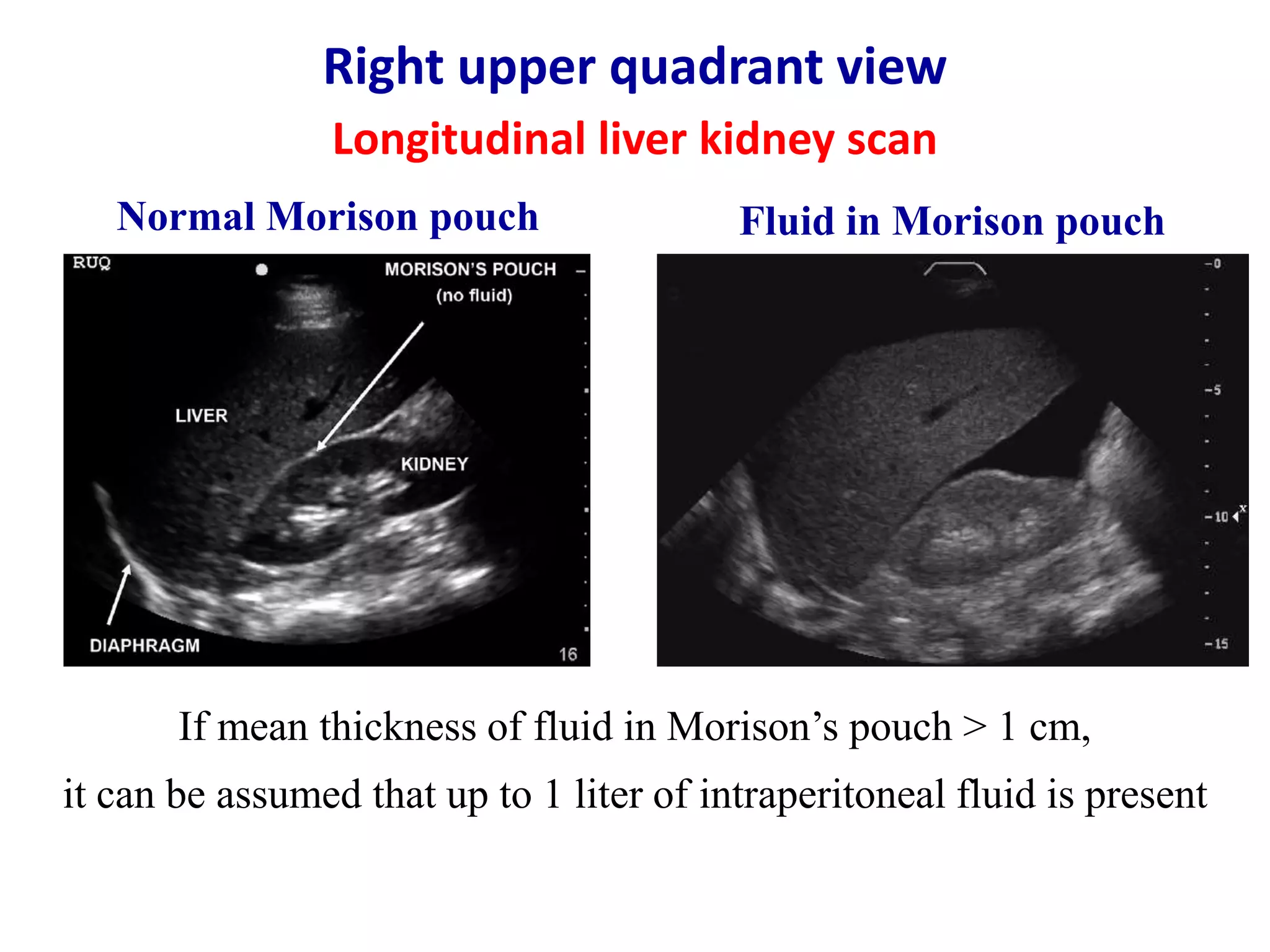 Extended focus assessment with sonography for trauma | PPTX