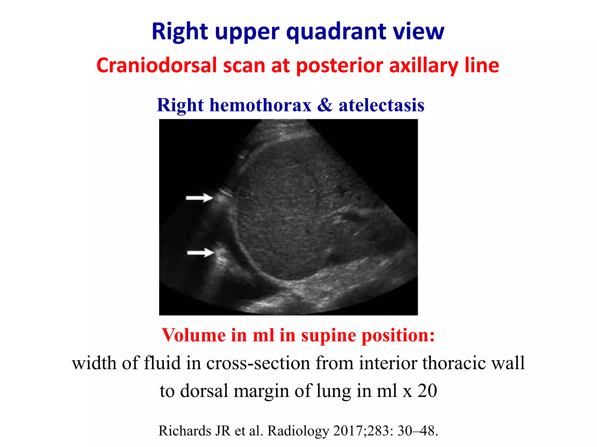 Extended focus assessment with sonography for trauma | PPTX