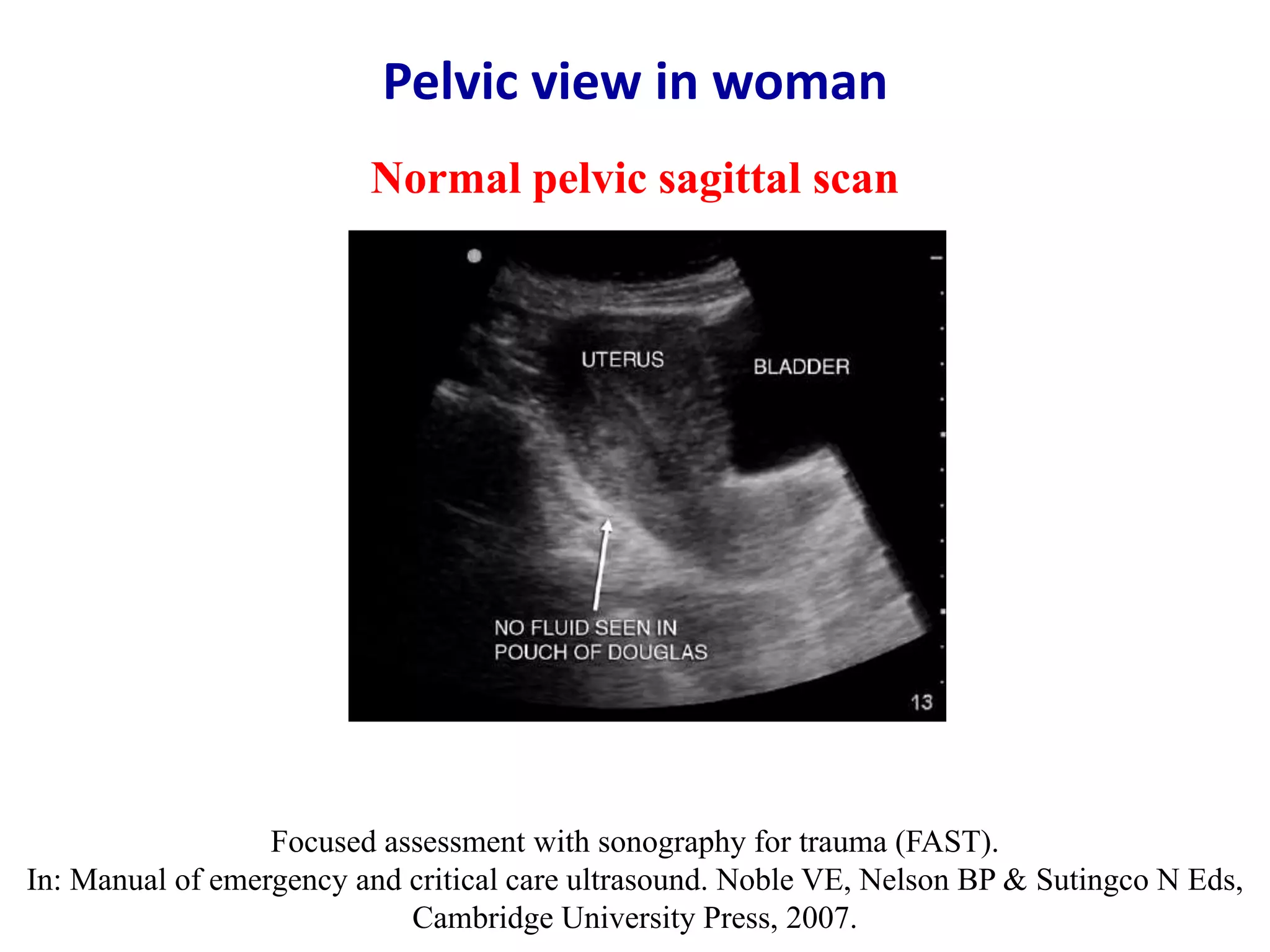 Extended focus assessment with sonography for trauma | PPTX