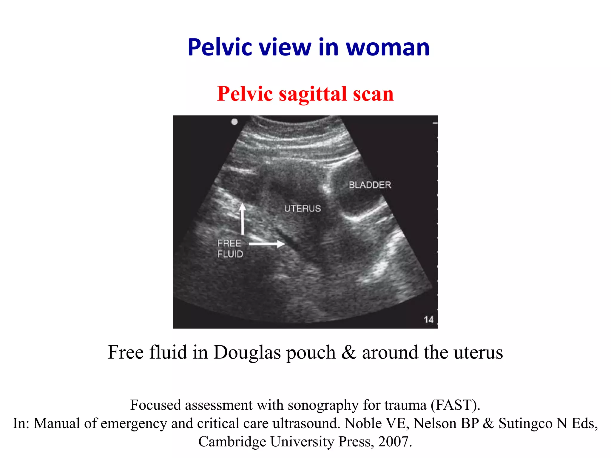Extended focus assessment with sonography for trauma | PPTX