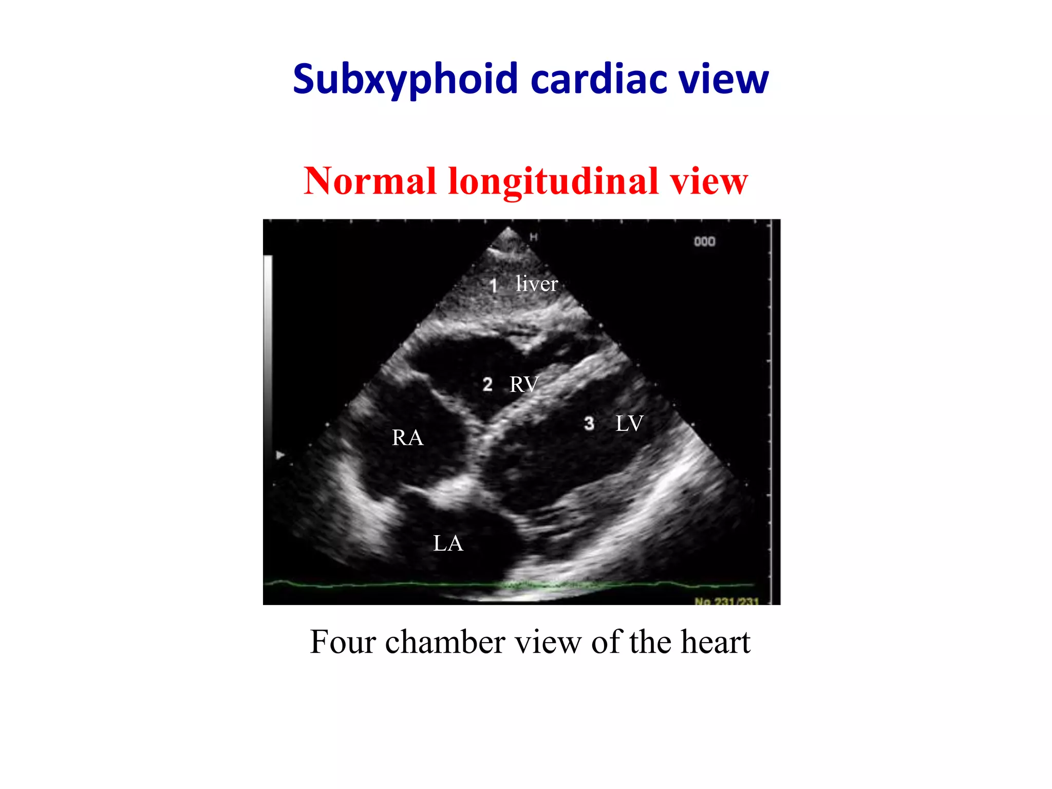 Extended focus assessment with sonography for trauma | PPTX