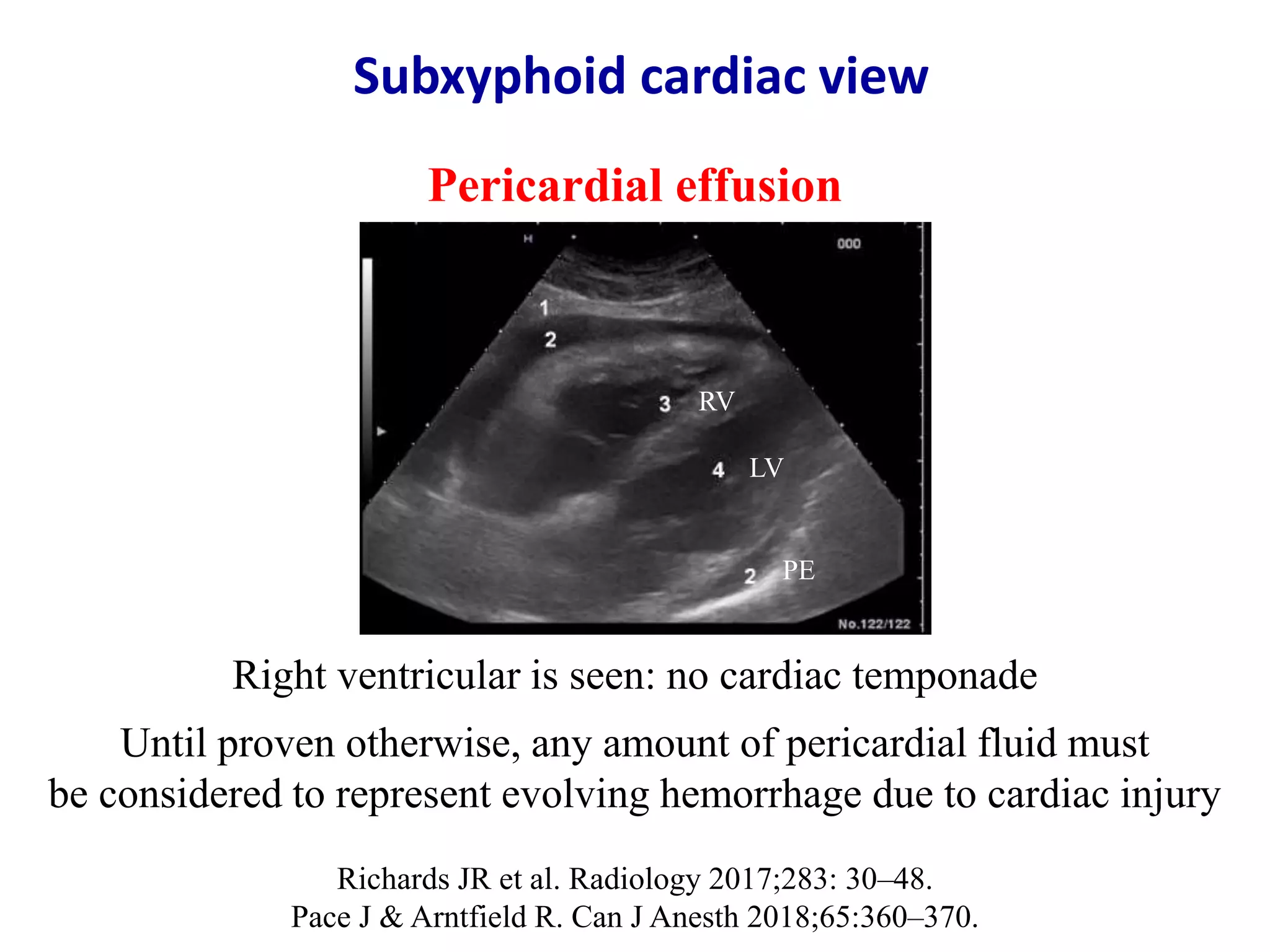 Extended focus assessment with sonography for trauma | PPTX