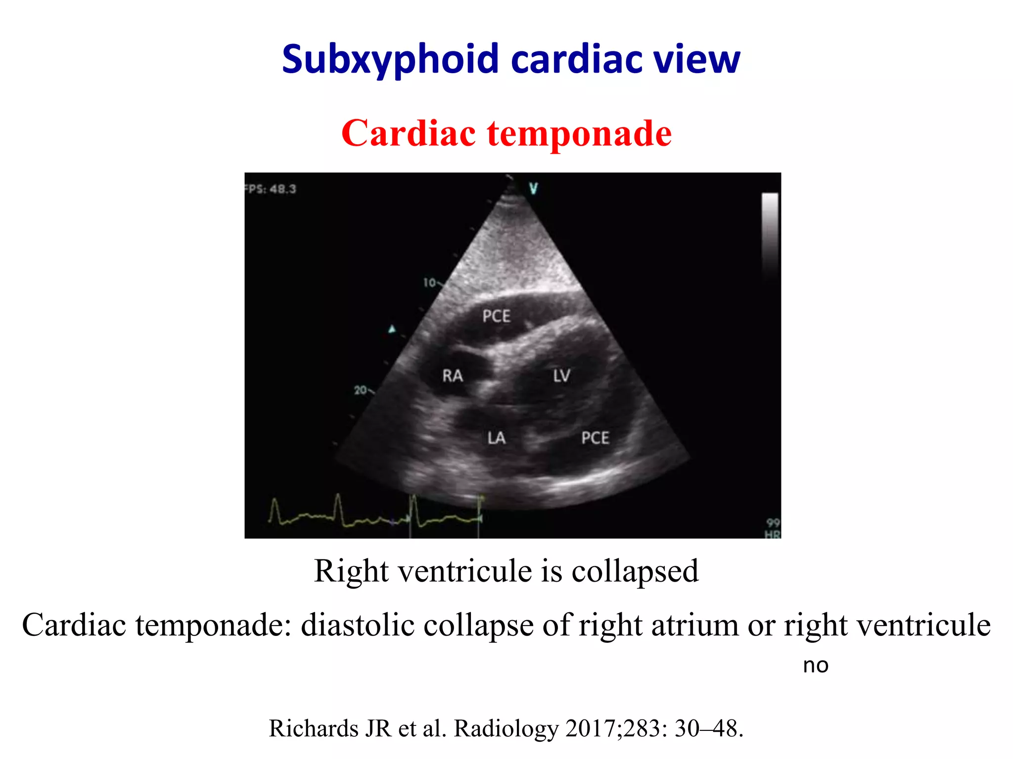 Extended focus assessment with sonography for trauma | PPTX