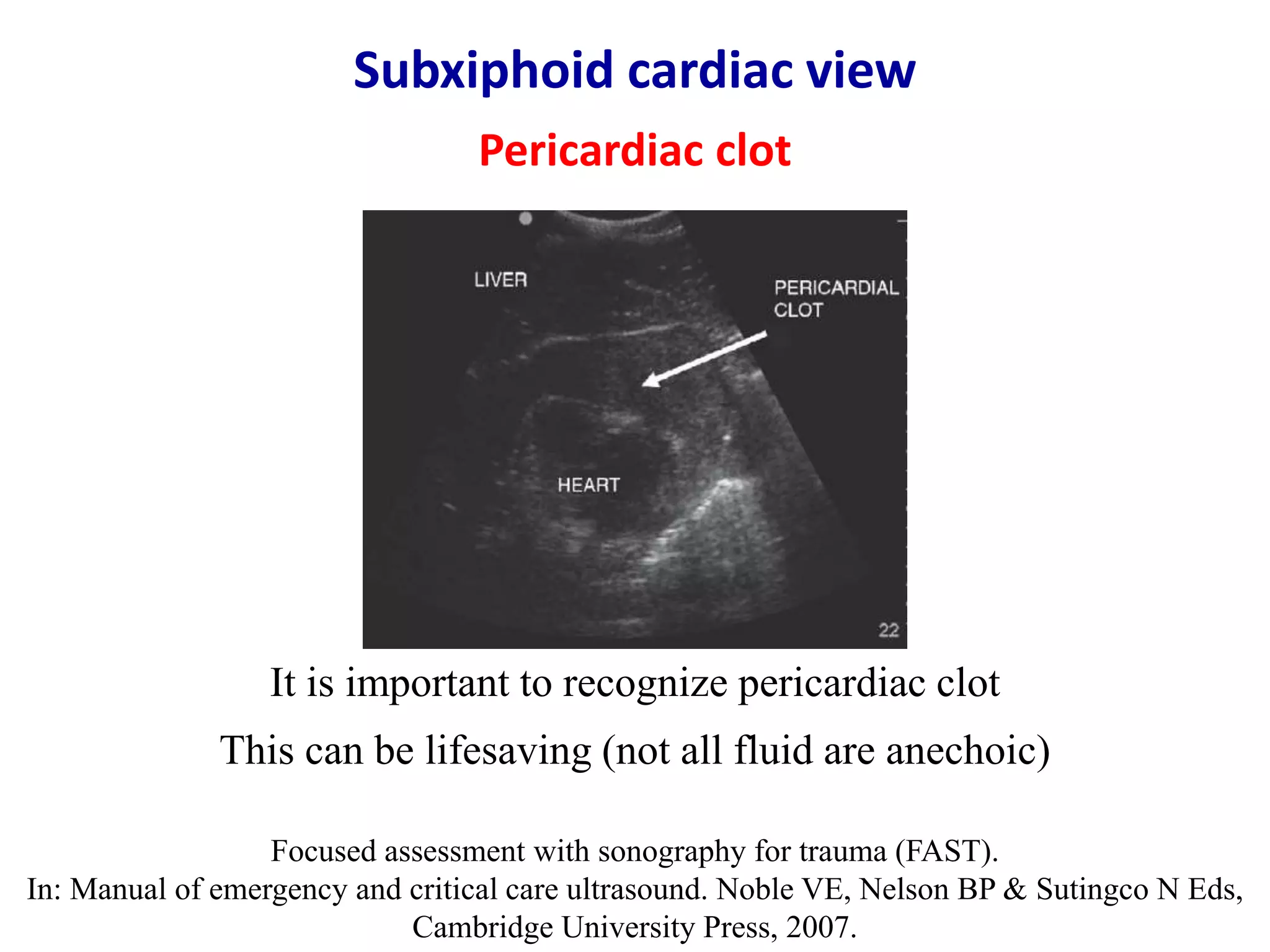 Extended focus assessment with sonography for trauma | PPTX