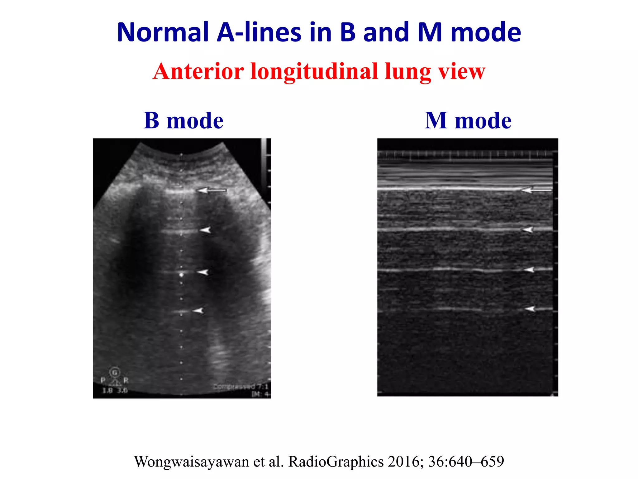 Extended focus assessment with sonography for trauma | PPTX