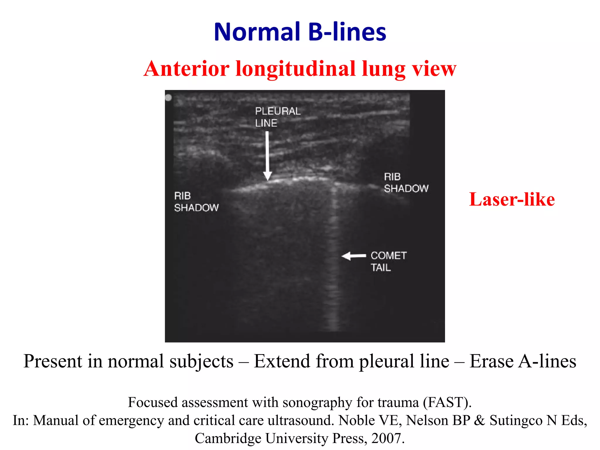 Extended focus assessment with sonography for trauma | PPTX