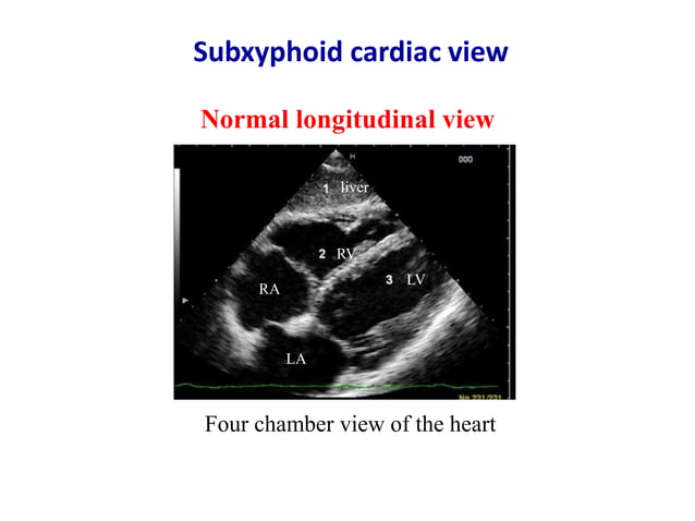 Extended focus assessment with sonography for trauma | PPTX | First Aid ...