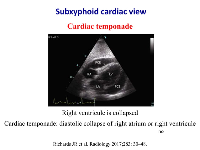 Extended focus assessment with sonography for trauma | PPTX | First Aid ...