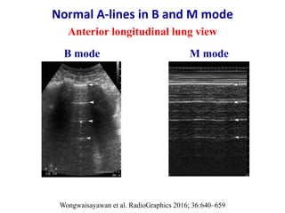 Extended focus assessment with sonography for trauma | PPTX