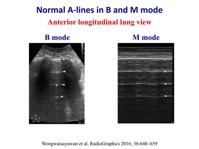 Extended focus assessment with sonography for trauma | PPTX | First Aid ...
