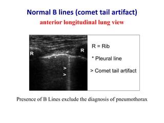 Extended focus assessment with sonography for trauma | PPTX