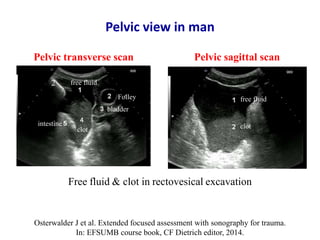 Rectouterine Pouch Ultrasound
