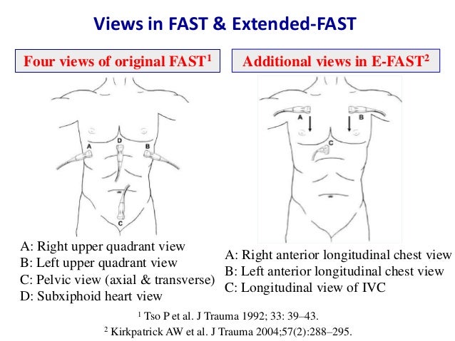 Extended focus assessment with sonography for trauma