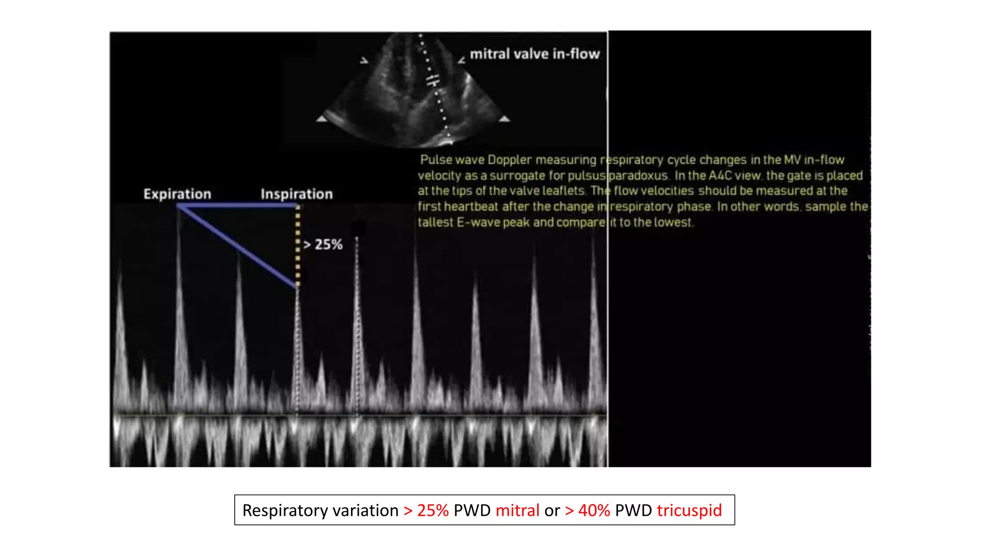 Focused bedside Echocardiography | PDF